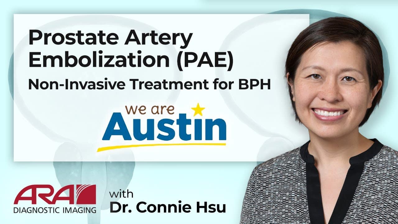 Prostate Artery Embolization: A Non-Invasive Treatment for BPH